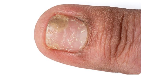 Blog Derme - Psoríase das unhas – Saiba mais